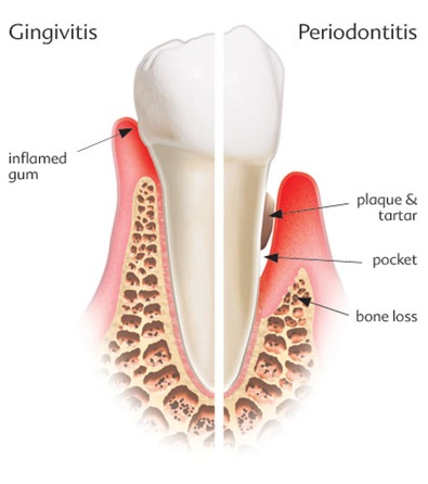 Laser Assisted Treatment For Gingivitis - Dental Center Vietnam