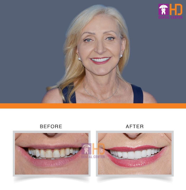 New Trend In Dentistry Dental Tourism - Dental Center Vietnam