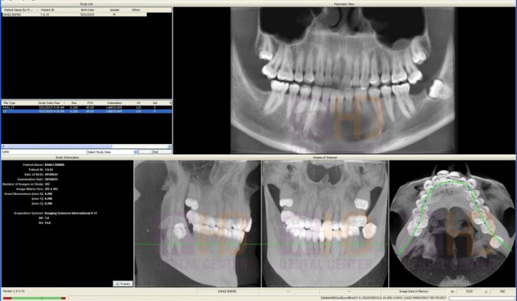 Porcelain Veneer, Crown Bridge Procedure - Dental Center Vietnam