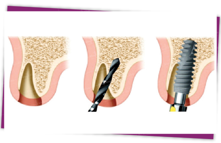Immediate Load Dental Implants - Dental Center Vietnam