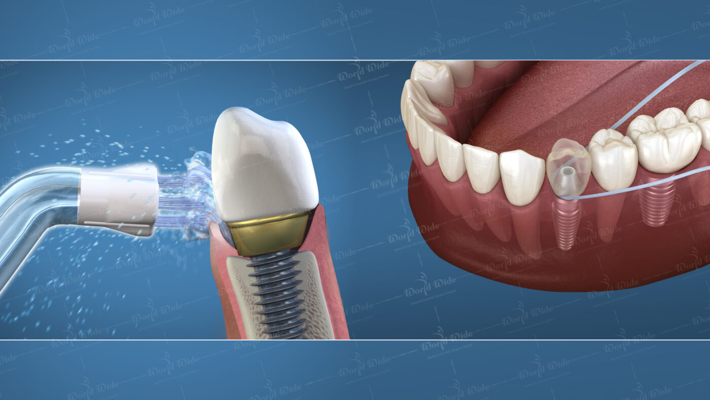 Implant Home Care Instruction - Dental Center Vietnam