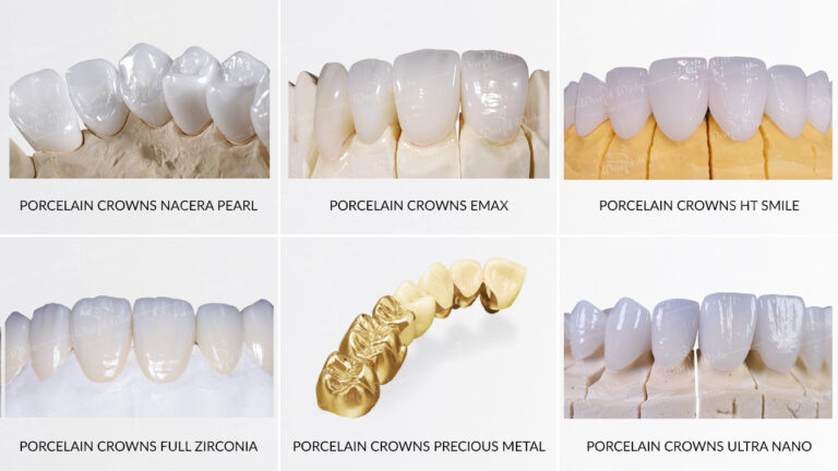 CROWN/VENEER MATERIALS AND PRODUCTION PROCEDURE - Dental Center Vietnam