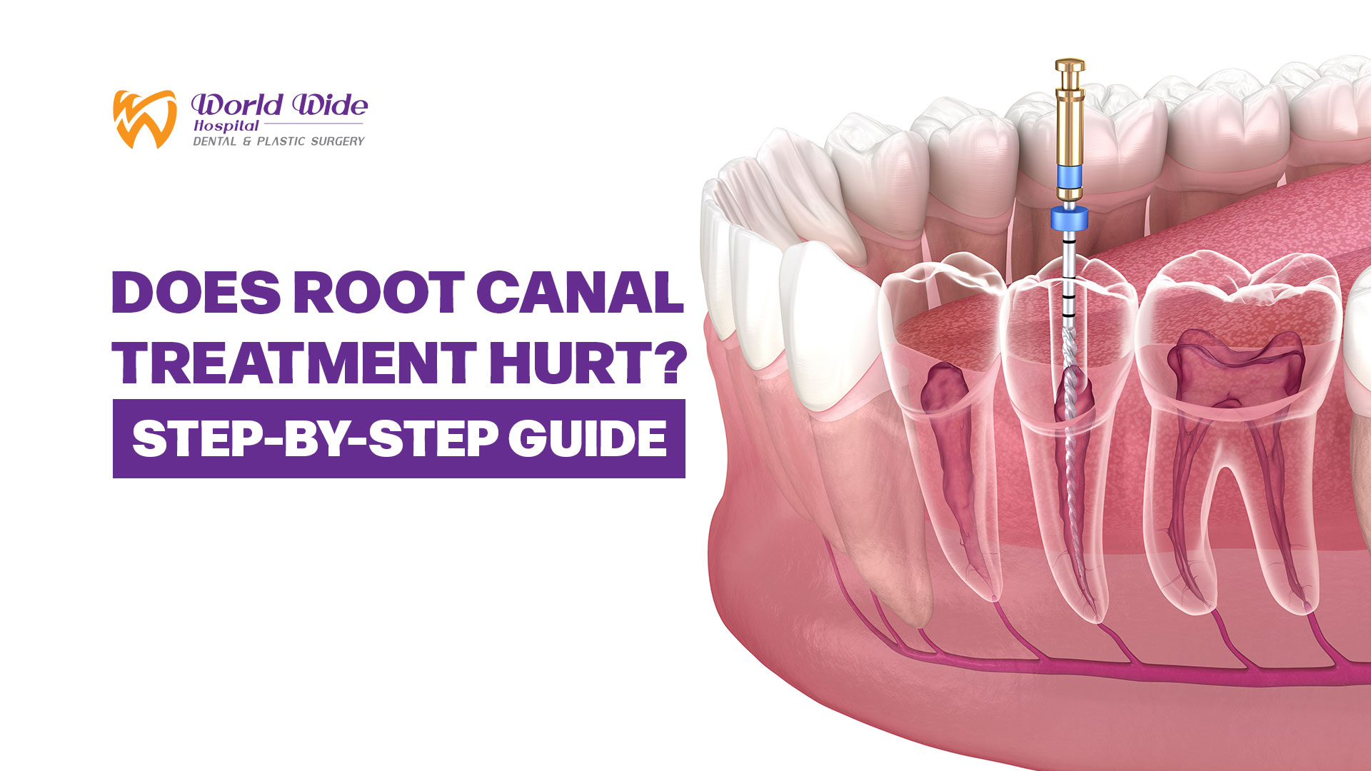 DOES ROOT CANAL TREATMENT HURT? STEP-BY-STEP GUIDE - Dental Center Vietnam