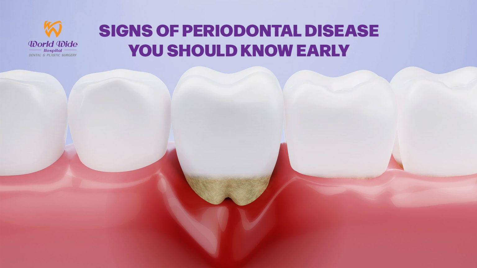 SIGNS OF PERIODONTAL DISEASE YOU SHOULD KNOW EARLY - Dental Center Vietnam