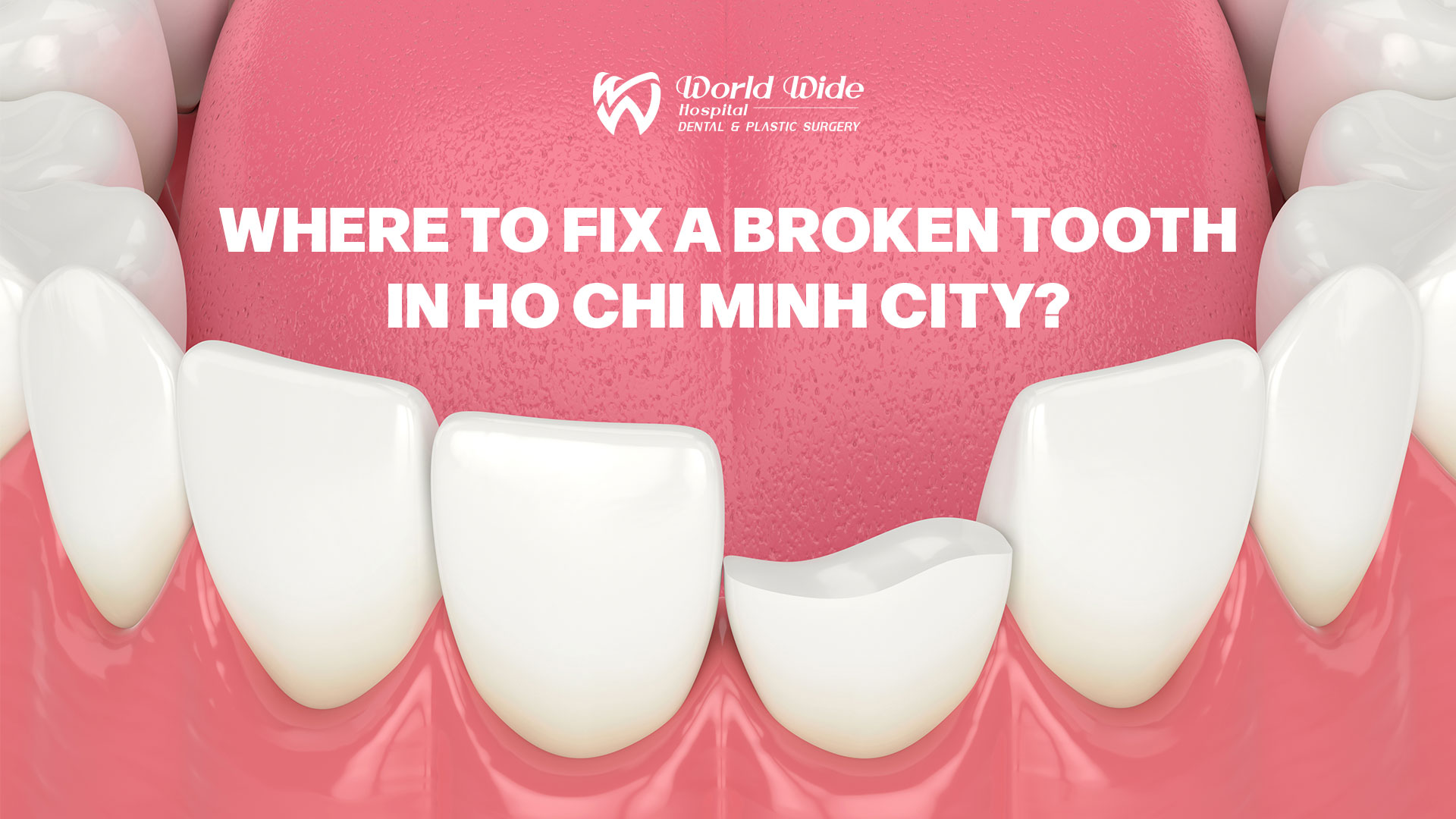 WHERE TO FIX A BROKEN TOOTH IN HO CHI MINH CITY? - Dental Center Vietnam