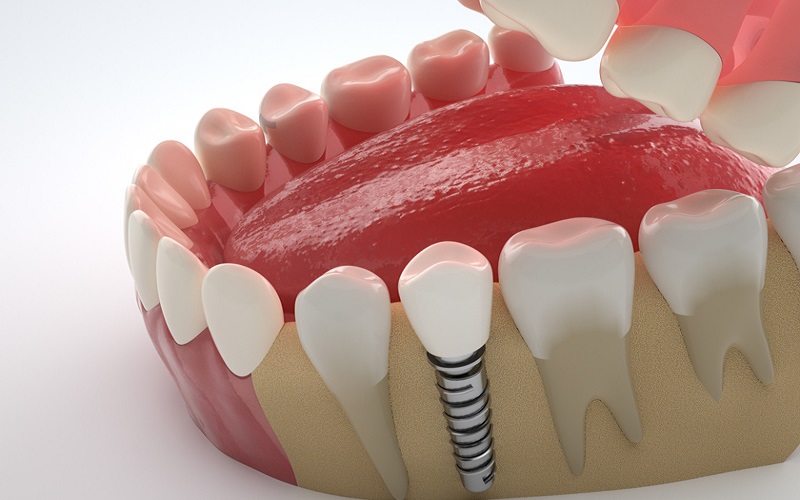 THE ROLE OF 3D CT SCANS IN IMPLANT PLANNING - Dental Center Vietnam