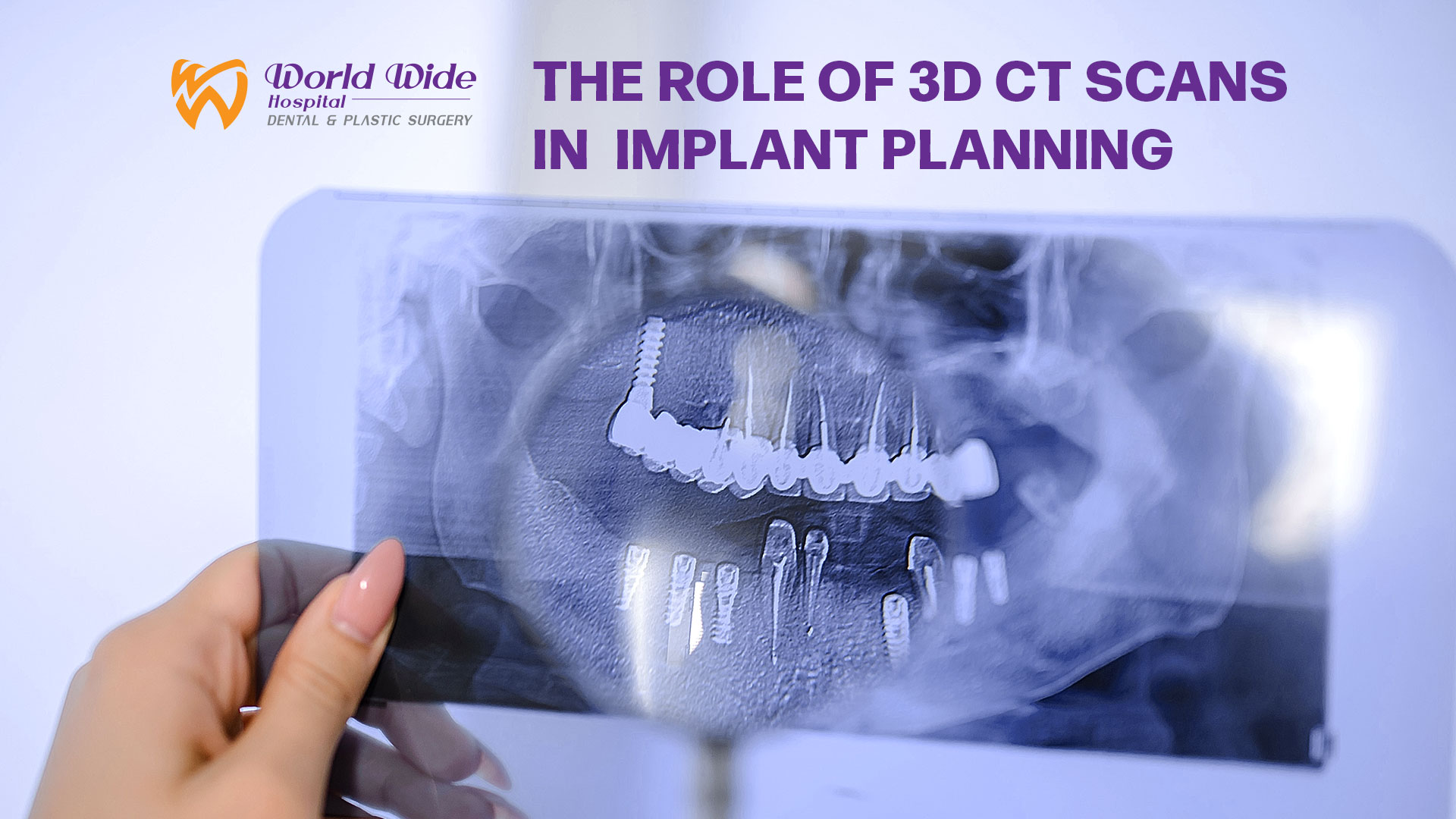 THE ROLE OF 3D CT SCANS IN IMPLANT PLANNING - Dental Center Vietnam